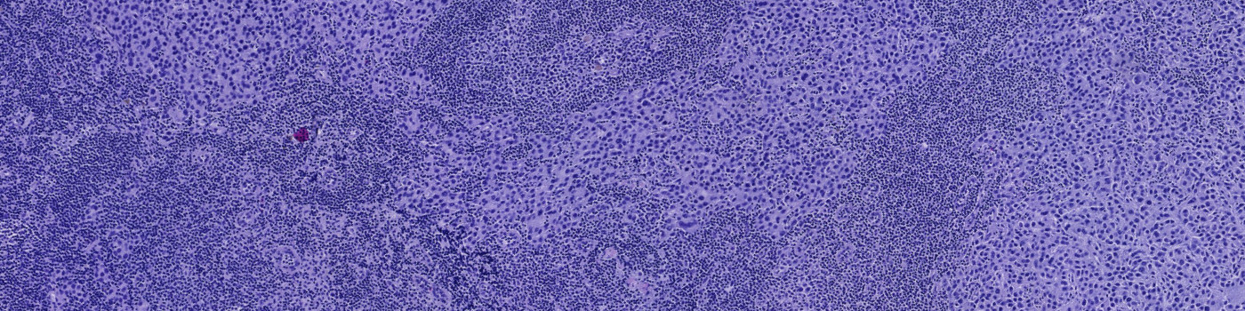 Metastasis Detection, AI - Visiopharm · Pathology image analysis software Metastasis Detection, AI - Visiopharm · Pathology image analysis software