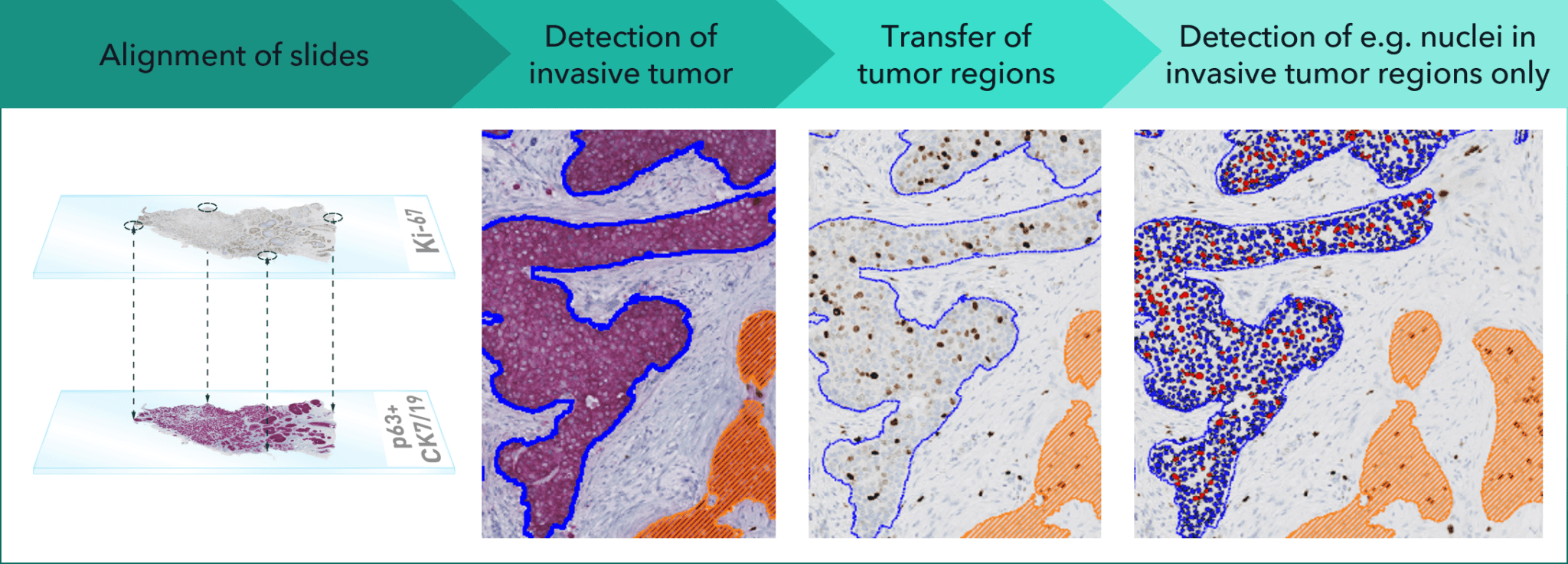 Invasive Tumor Detection (PDS) - Visiopharm · Pathology image analysis ...